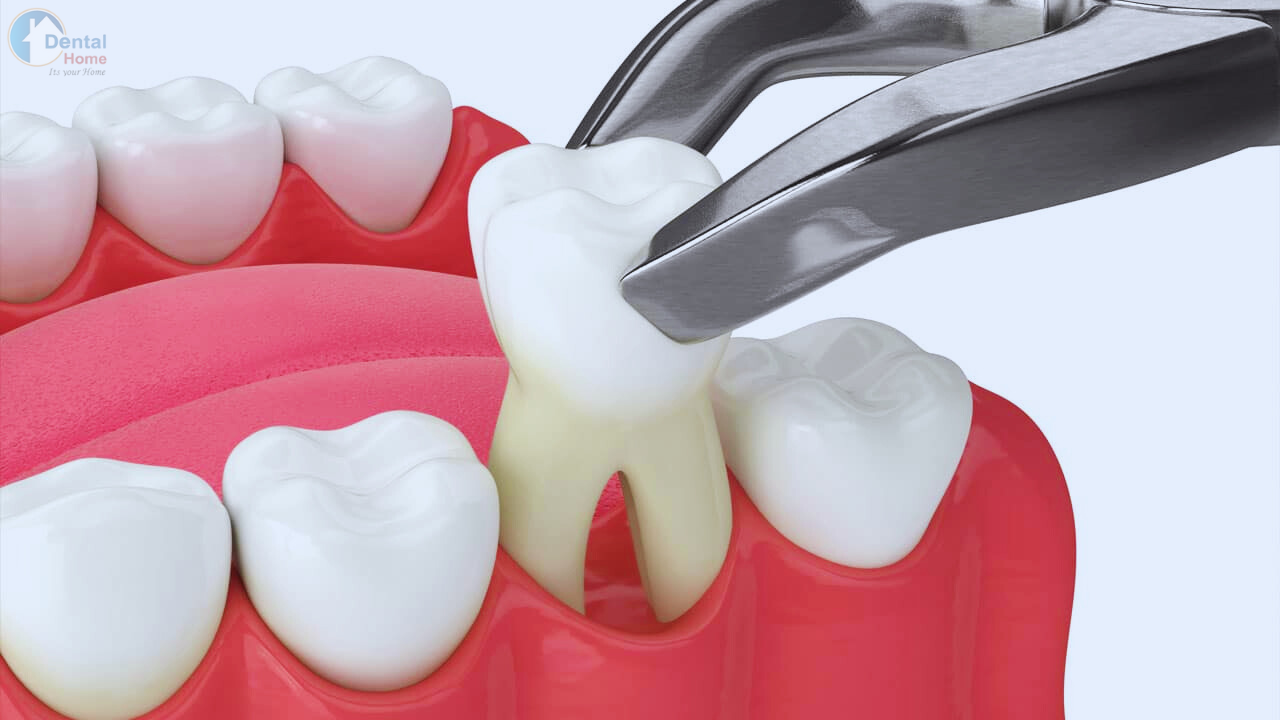 Benefits of Tooth Extraction | Dental Home BD